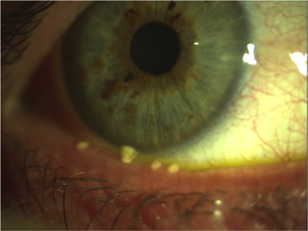 Dry Eye